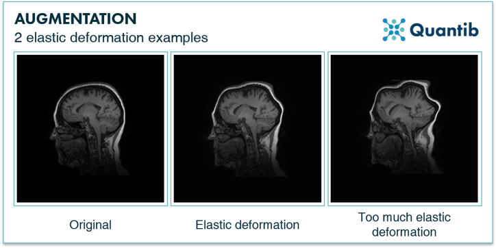 Image augmentation: how to overcome small radiology datasets